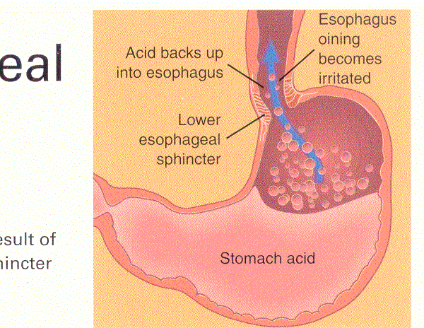 Gerd Animated Gifs | Photobucket